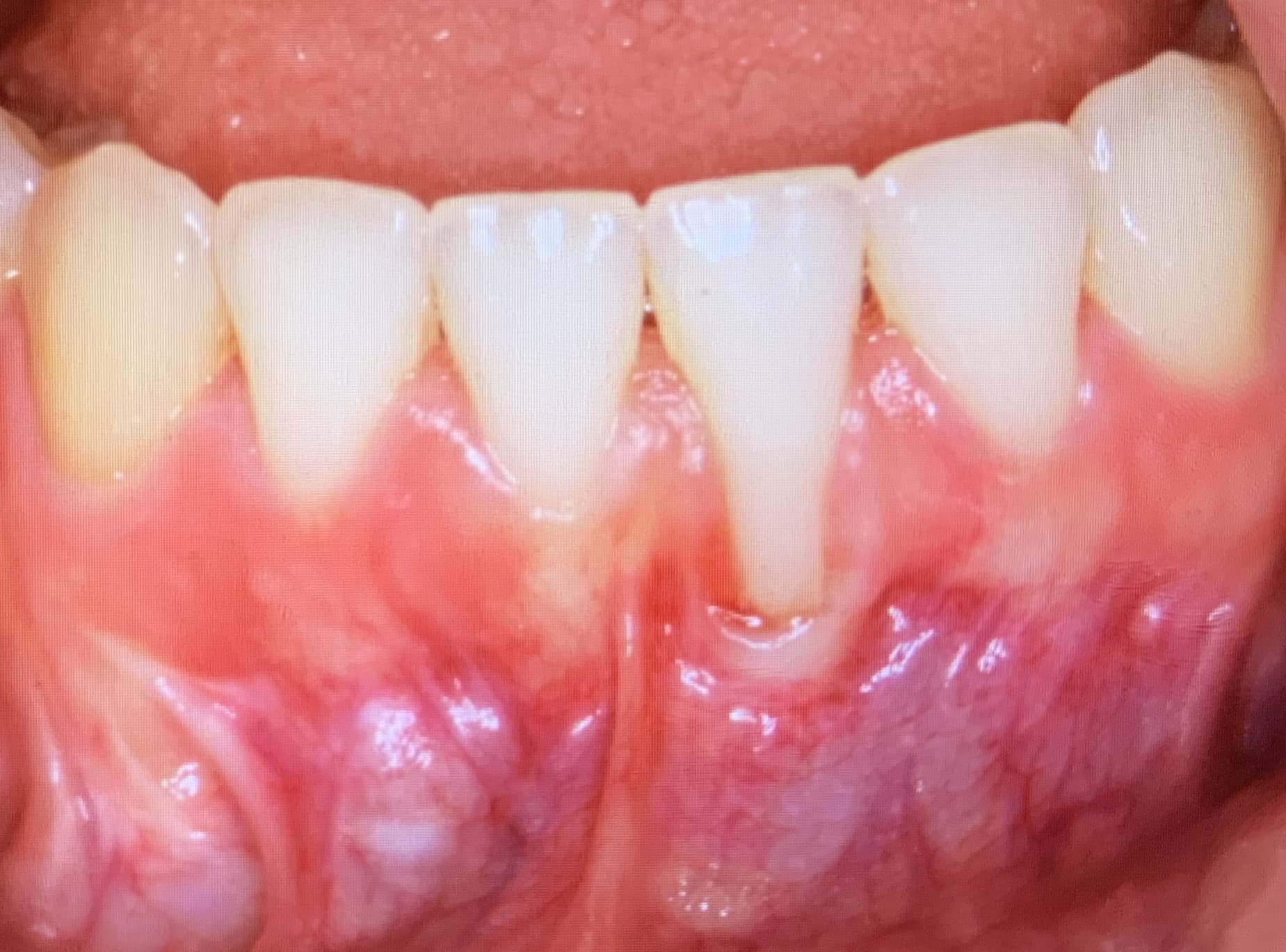 Free Gingival Grafts - Littleton Implant and Periodontics