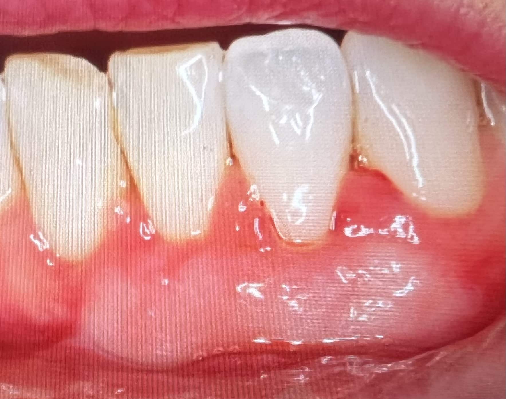 Free Gingival Grafts - Littleton Implant and Periodontics