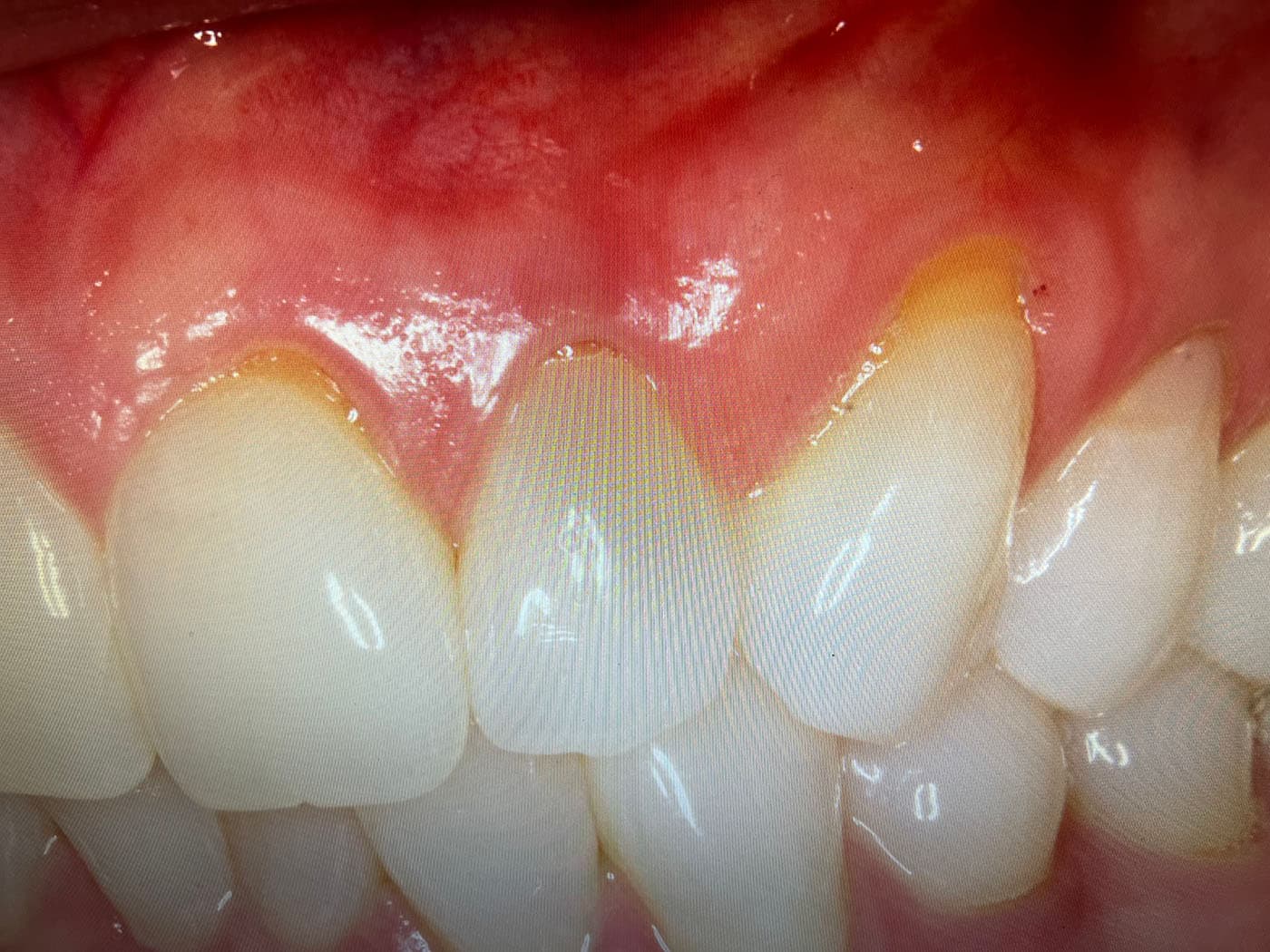 Connective Tissue Grafting - Littleton Implant and Periodontics